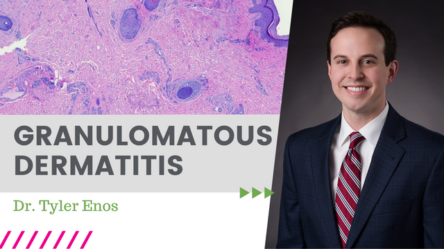 Granulomatous Dermatitis | Sagis