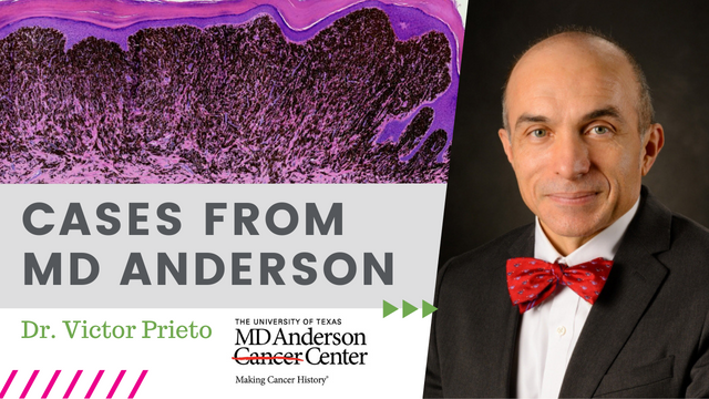 Cases From MD Anderson | Sagis