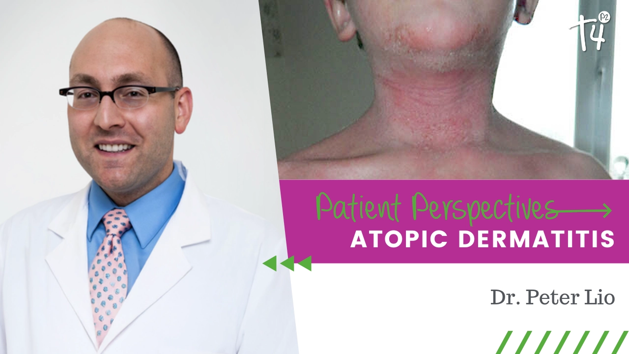 Atopic Dermatitis & Topical Steroid Withdrawal (TSW) Syndrome | Sagis