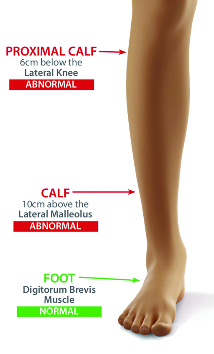 Epidermal Nerve Fiber Density (ENFD) | Sagis
