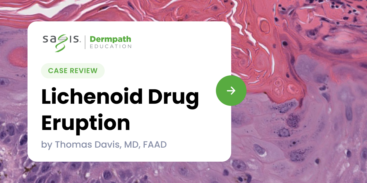 Lichenoid Drug Eruption | Sagis